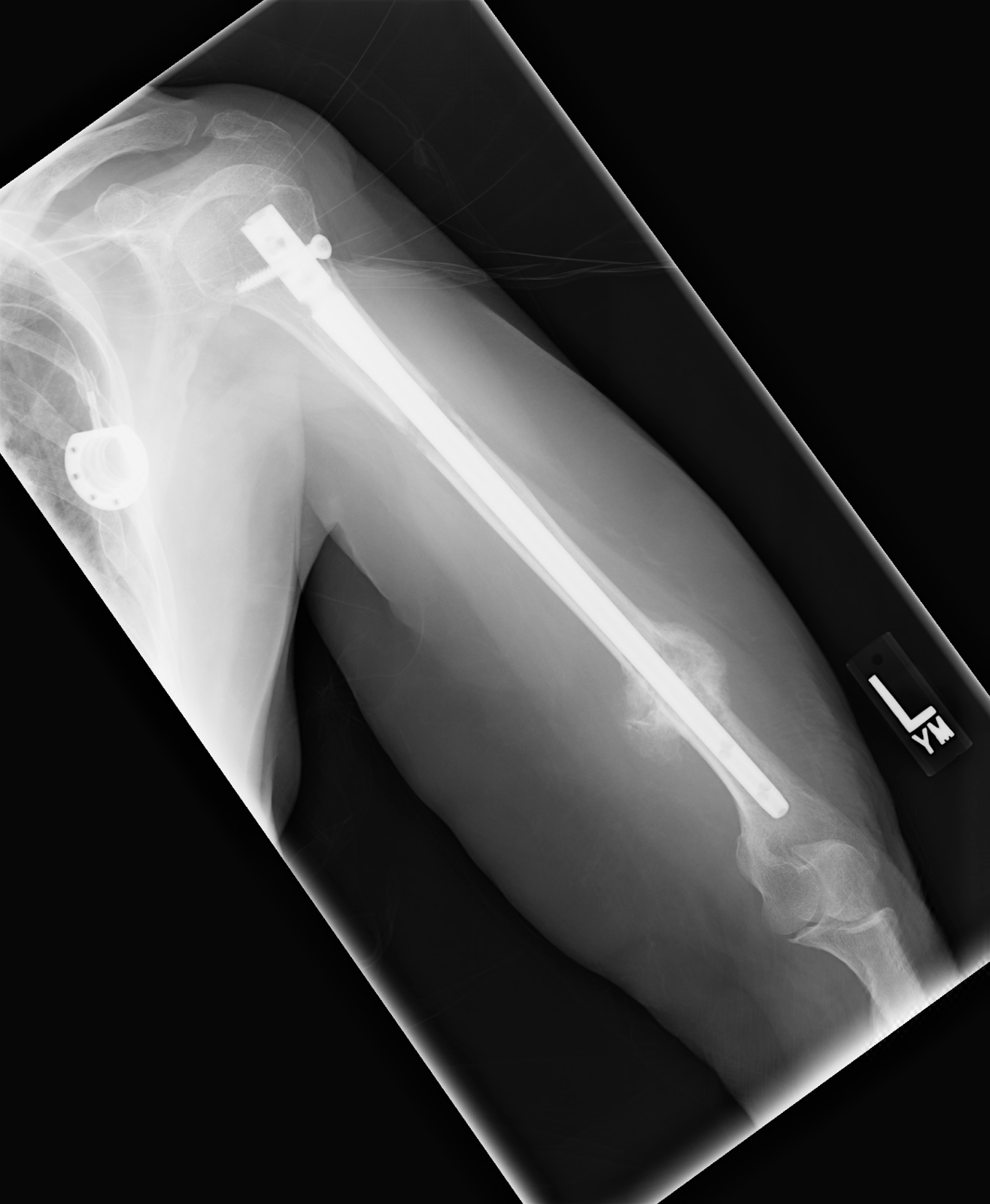 Shoulder and Elbow Surgery: Intramedullary nailing of bilateral ...