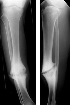 Non Union Fracture Treatment | Non Union Bone Fracture Surgery