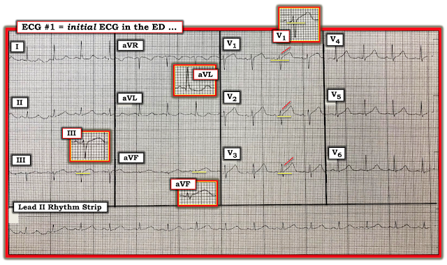 Dr. Smith's ECG Blog: The computer and the cardiologist called this a ...