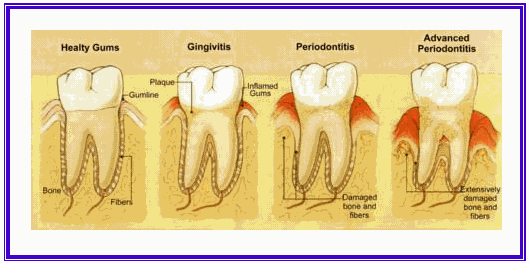 ENFERMEDADES PERIODONTALES: PERIODONTITIS