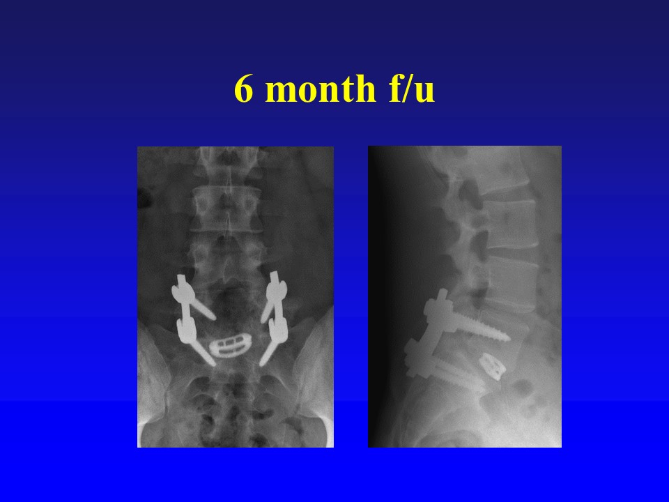 Spondylolysis/Pars Fracture: Surgical Treatment Part 6 | Growing Spine ...
