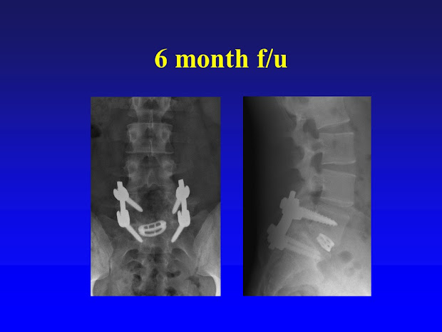 Spondylolysis/Pars Fracture: Surgical Treatment Part 6 | Growing Spine ...