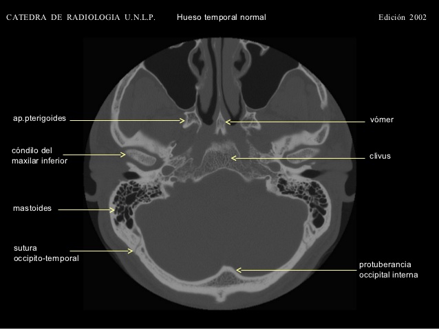 ANATOMÍA: Tejido óseo. EL CRÁNEO. TC, TAC, Rx, RADIOGRAFÍA.
