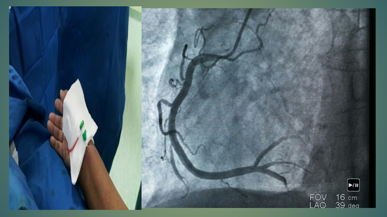 Angiografi koroner (Coronary angiography) | Portal Medis | Portal ...