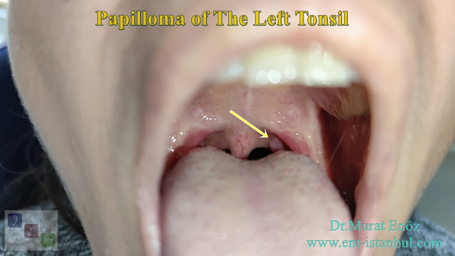 The Frequency Of Hpv Infection In The Ear Nose And Throat Area Is Increasing