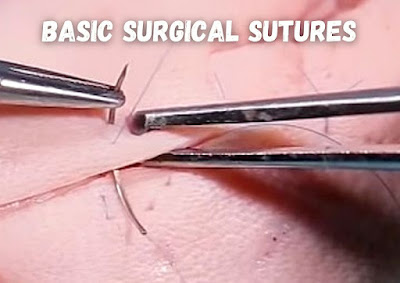 ORAL SURGERY: Basic surgical sutures - Paweł Sawicki, DDS