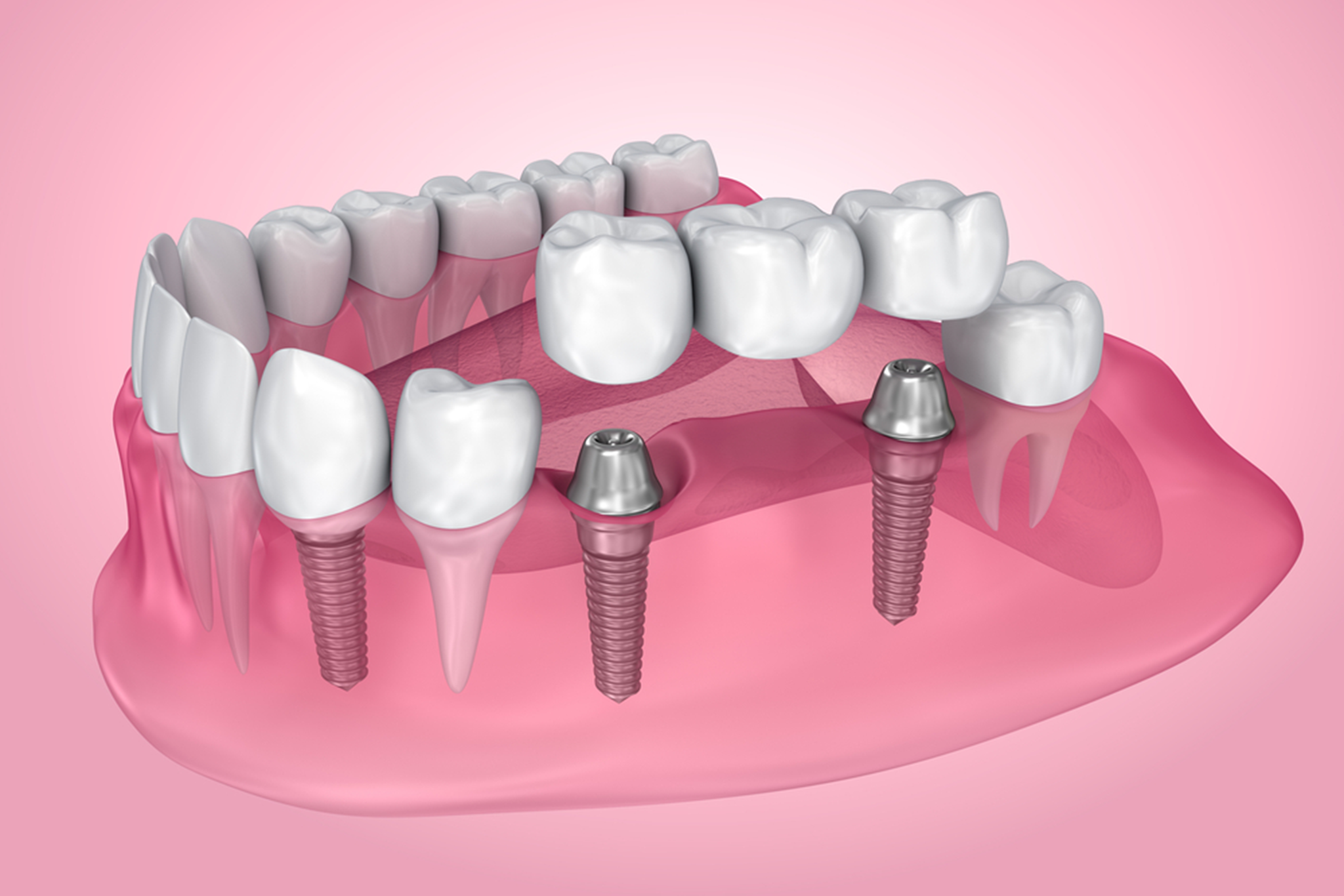 Dentist in NW Calgary: The Advantages of Implant-Supported Dental Bridges