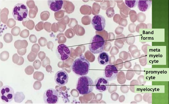 Chronic Myeloid Leukemia (CML)