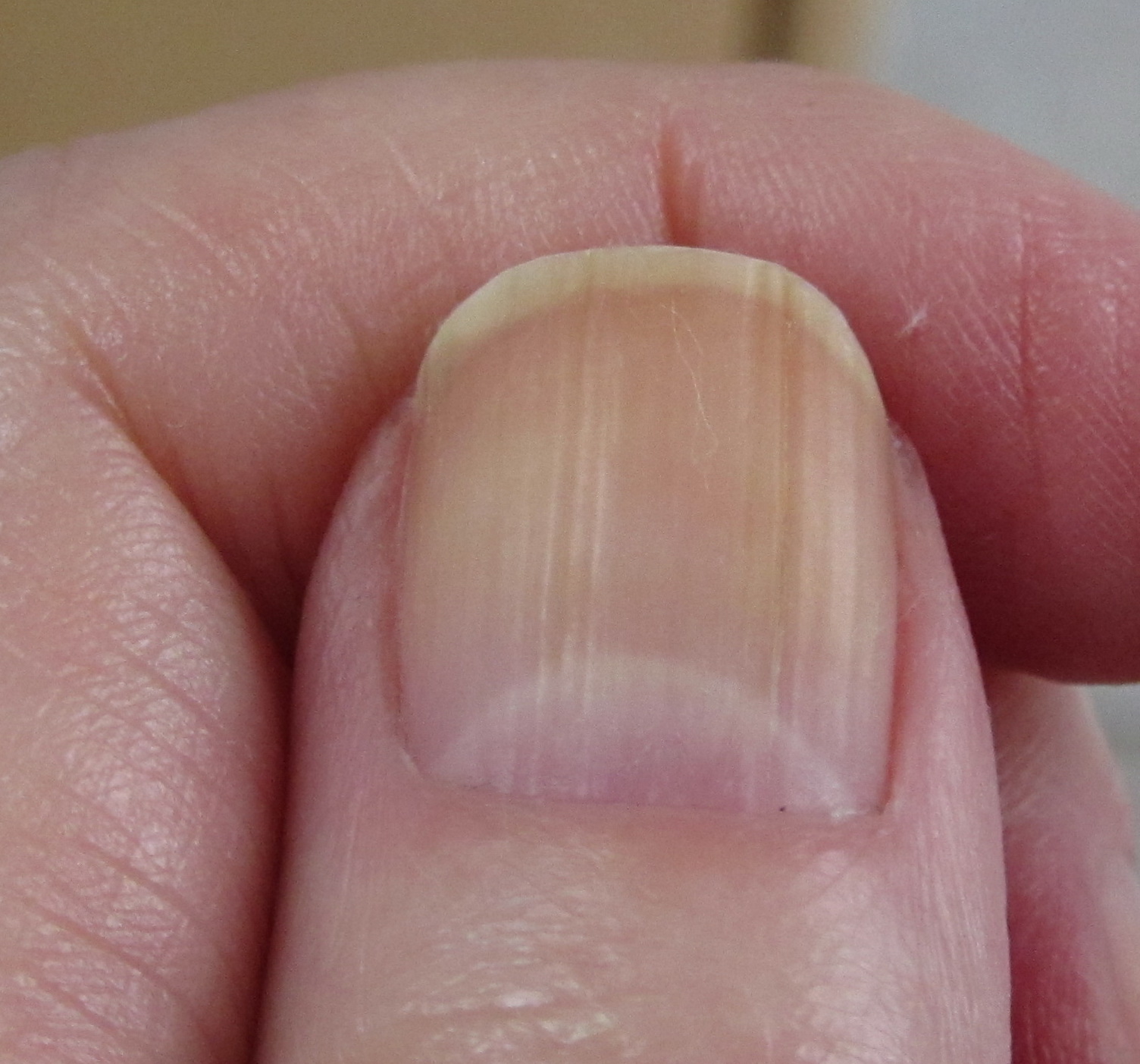 Marias Nail Art and Polish Blog: 1½ months of repairing a ripped/torn ...