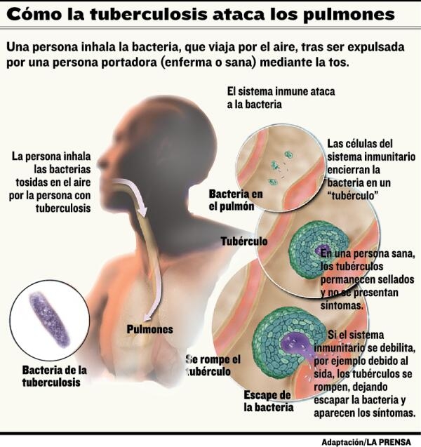 TUBERCULOSIS LATENTE Y LETAL: TUBERCULOSIS PULMONAR