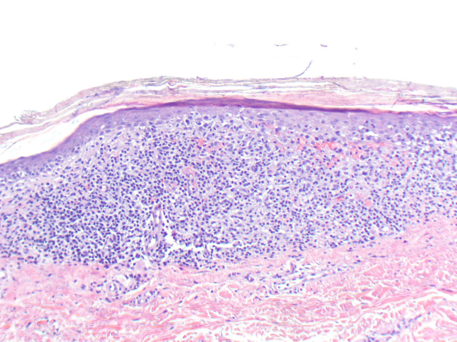 VIRTUAL GRAND ROUNDS IN DERMATOLOGY 2.0: Mycosis Fungoides