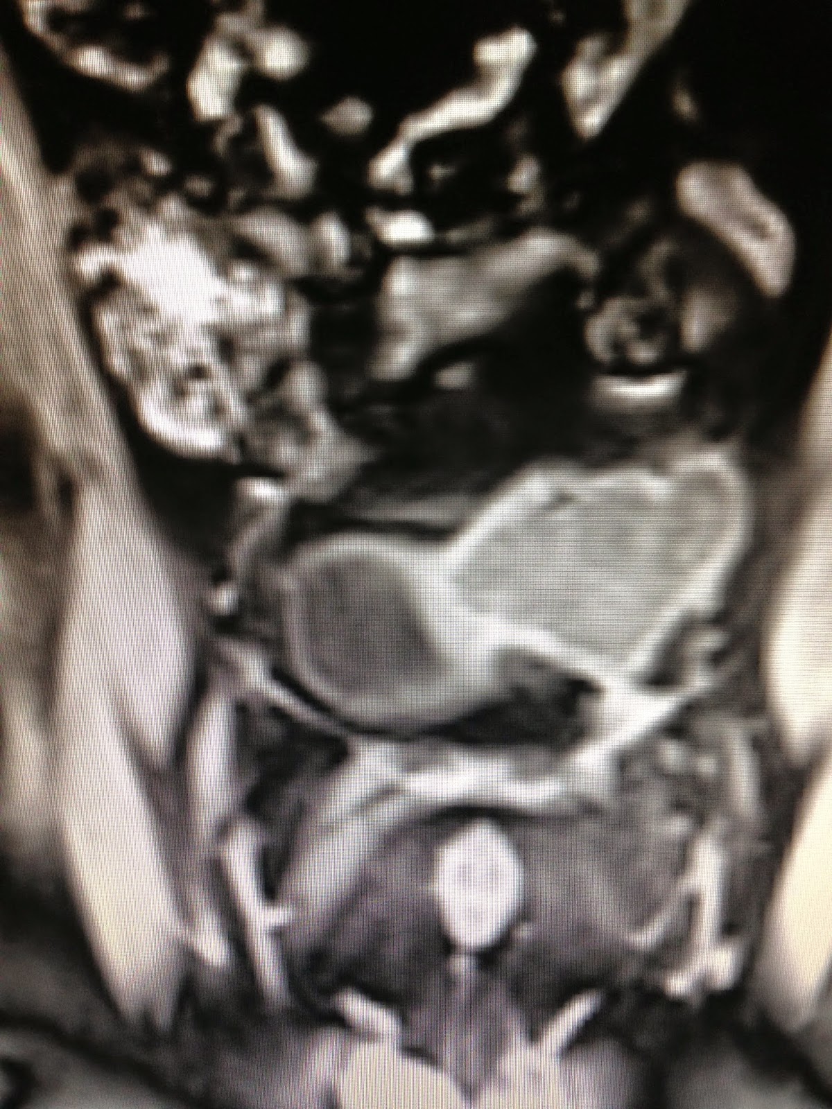 VIETNAMESE MEDIC ULTRASOUND: CASE 282: SUPRAPUBIC MASS, Dr PHAN THANH ...