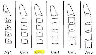NYC Orthodontist: THE CVM METHOD AND THE IDEAL TIME FOR ORTHODONTIC ...