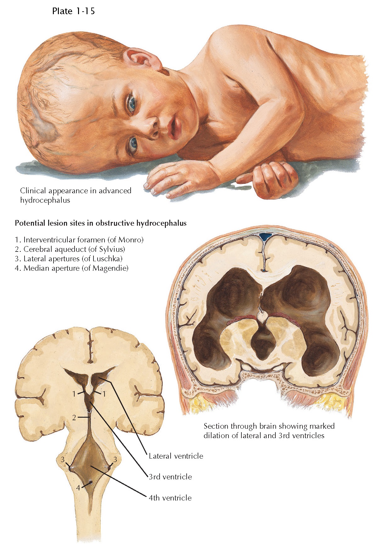 HYDROCEPHALUS - pediagenosis