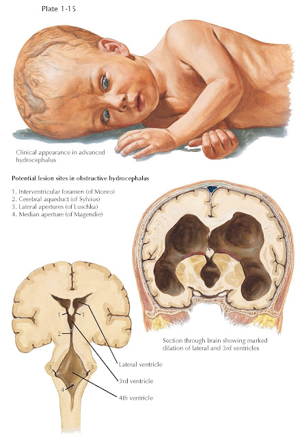 HYDROCEPHALUS - pediagenosis