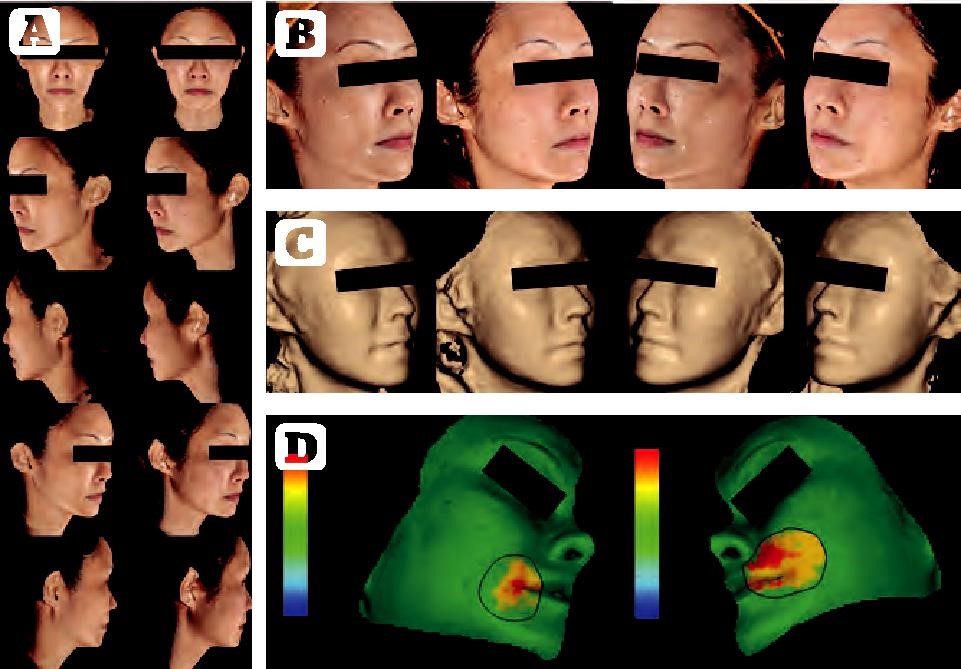 Facial Overfilled Syndrome Complications of Inappropriate Filler Delivery