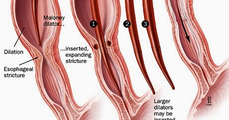 ENT Blogs: ESOPHAGEAL STRICTURE