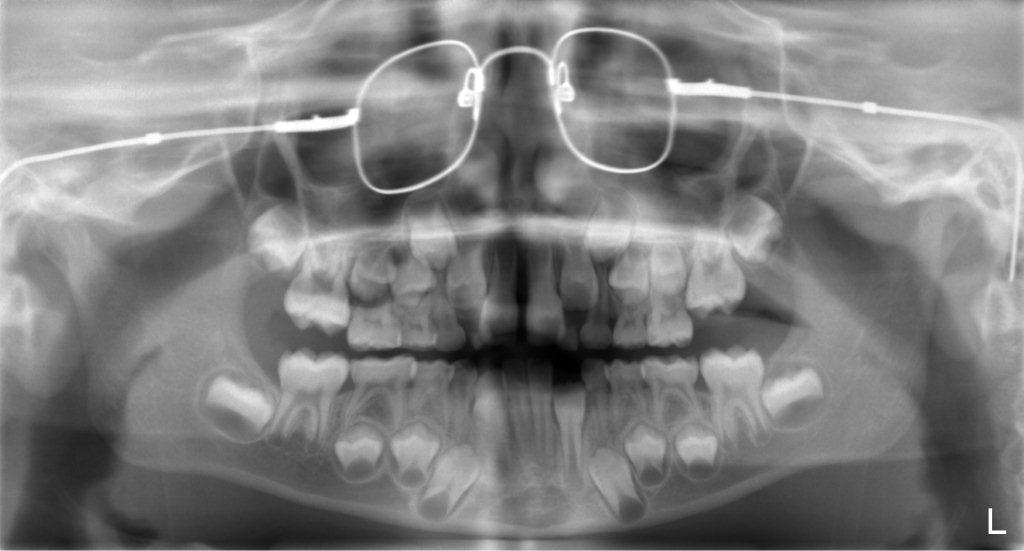 Blessed Beyond Measure: braces