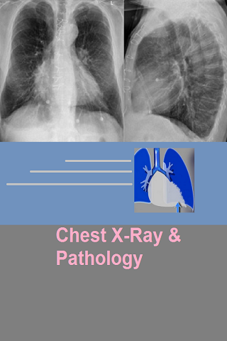 CHEST X RAY AND PATHOLOGY - Radiology Imaging