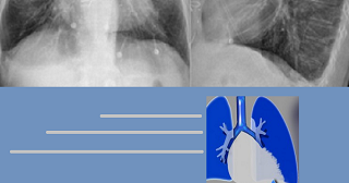 CHEST X RAY AND PATHOLOGY - Radiology Imaging