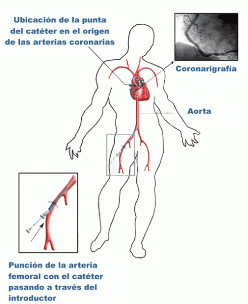Enfermeras a cuadros: Cateterismo o coronariografía