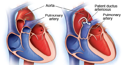 MEDI LEARNER: PATENT DUCTUS ARTERIOSUS (PDA)