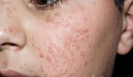 Photos of Warts on Face ~ How To Remove Moles, Warts, Skin Tags Safely