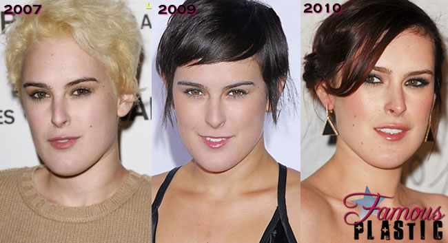 Rumer Willis Chin Before And After