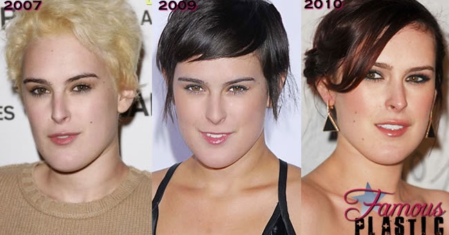 Rumer Willis Plastic Surgery Before and After Breast Implants and Lips