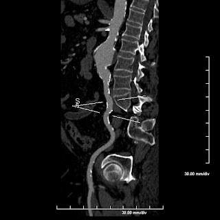 Other Scans for AAA: CT