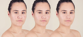 The Acne Cycle - Sokle Rev