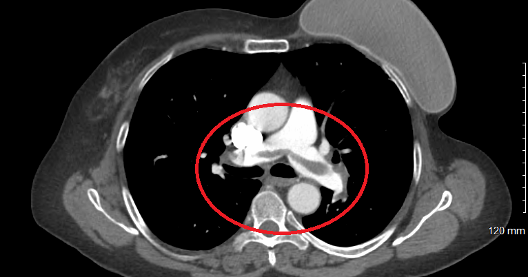 Chronicles Of My Residency: "That is a huge PE!!" Massive versus ...