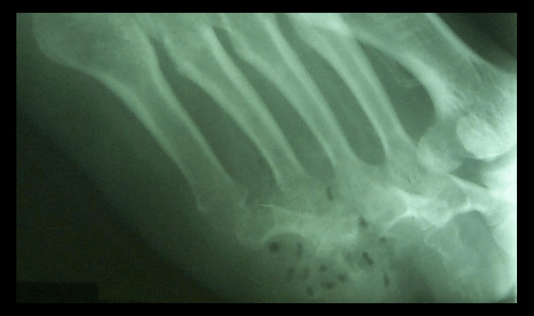 Tecnicos Radiologos: Pie diabético: hallazgos en Diagnóstico por Imagen ...