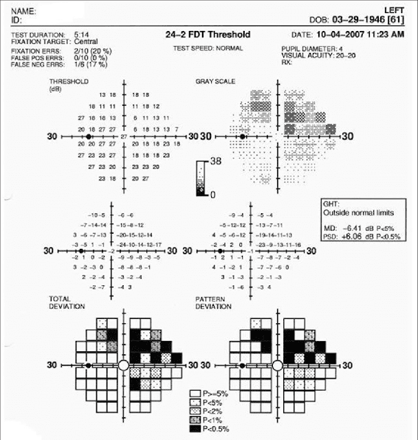GLAUCOMA SPECIALIST BLOG: "THE GLOG": FREQUENCY DOUBLING TECHNOLOGY