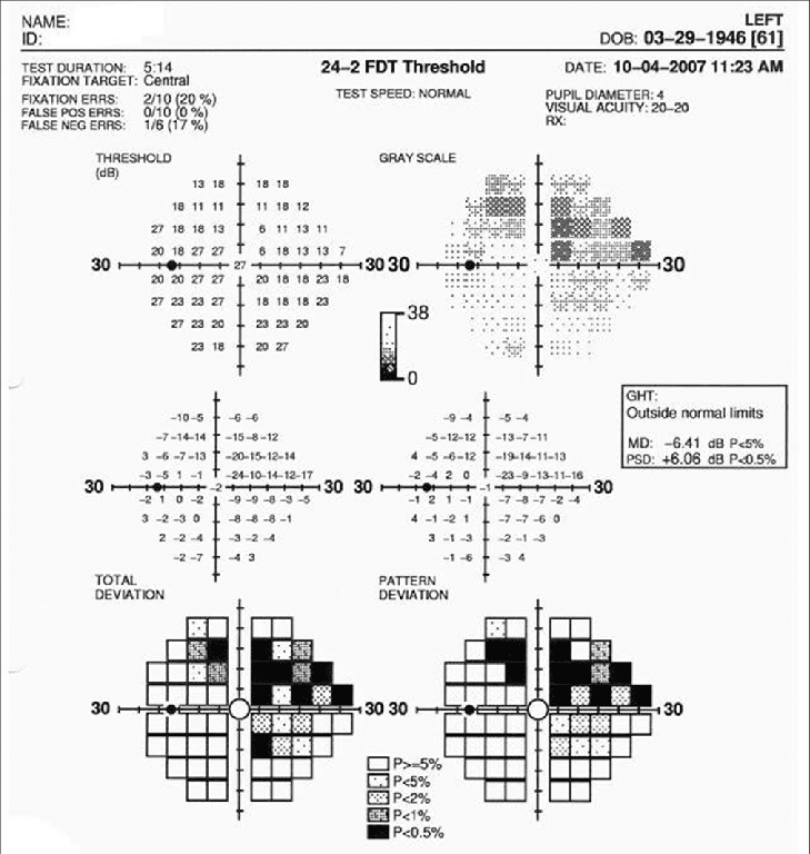 GLAUCOMA SPECIALIST BLOG: "THE GLOG": FREQUENCY DOUBLING TECHNOLOGY