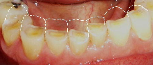 Dental Care of Corona: The Daily Grind: What Wears Down Your Teeth