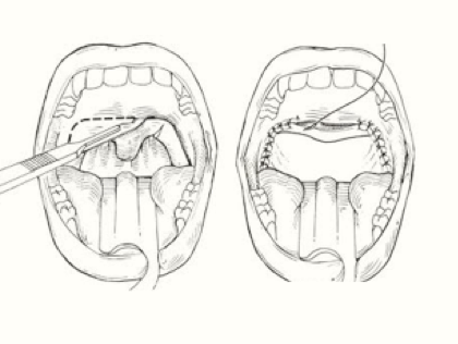 ΕΥίασις Μαρούσι: Treating snoring and sleep apnea