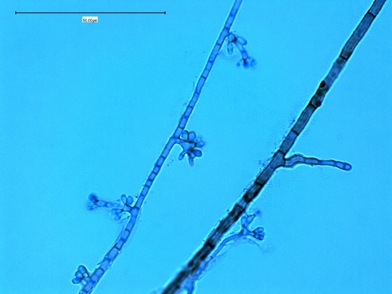 Fun With Microbiology (What's Buggin' You?): Fonsecaea pedrosoi/monophora