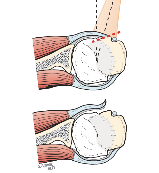 UW Shoulder and Elbow Academy: Subscapularis failure after shoulder ...