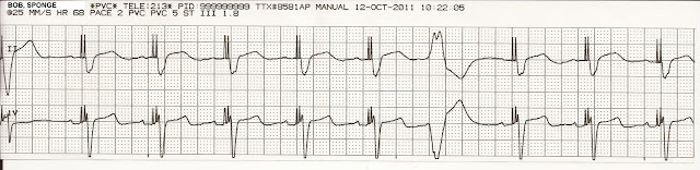 EKG Rhythm Strips 22: Paced Rhythms