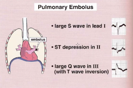 MBBS Medicine (Humanity First): Pulmonary Embolism - EKG Findings