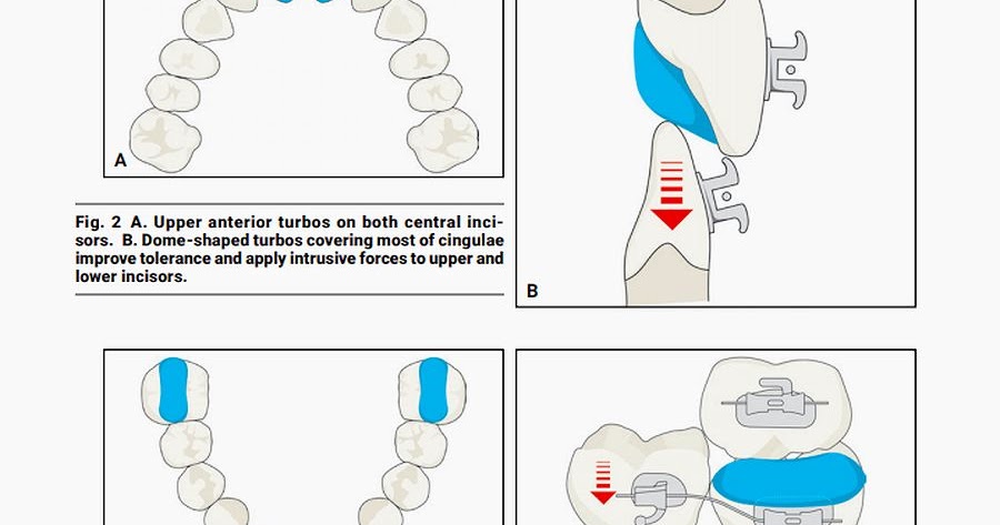 PDF: Resin Bite Turbos - Ovi Dental
