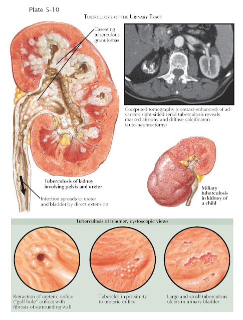 TUBERCULOSIS - pediagenosis