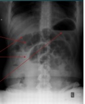 PROTOCOLO DE ESTUDIOS ESPECIALES: TRÁNSITO INTESTINAL