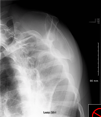 Shoulder and Elbow Surgery: Locked scapula syndrome (or scapular ...