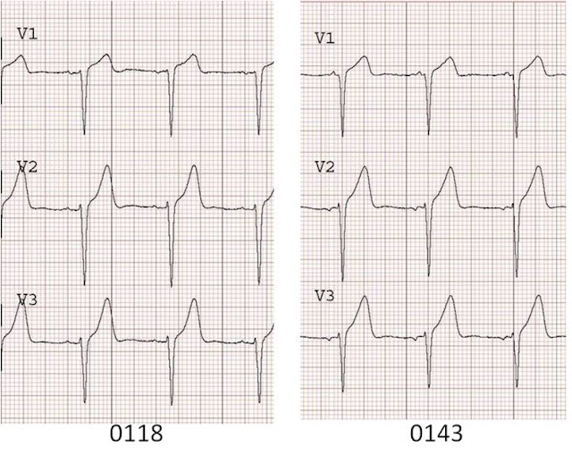 Dr. Smith's ECG Blog: Acute anterior STEMI from LAD occlusion, or ...