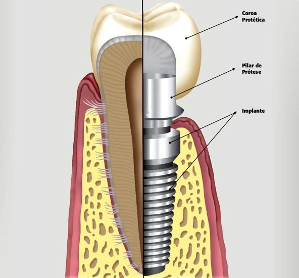 Odontologia Nacif: Implante