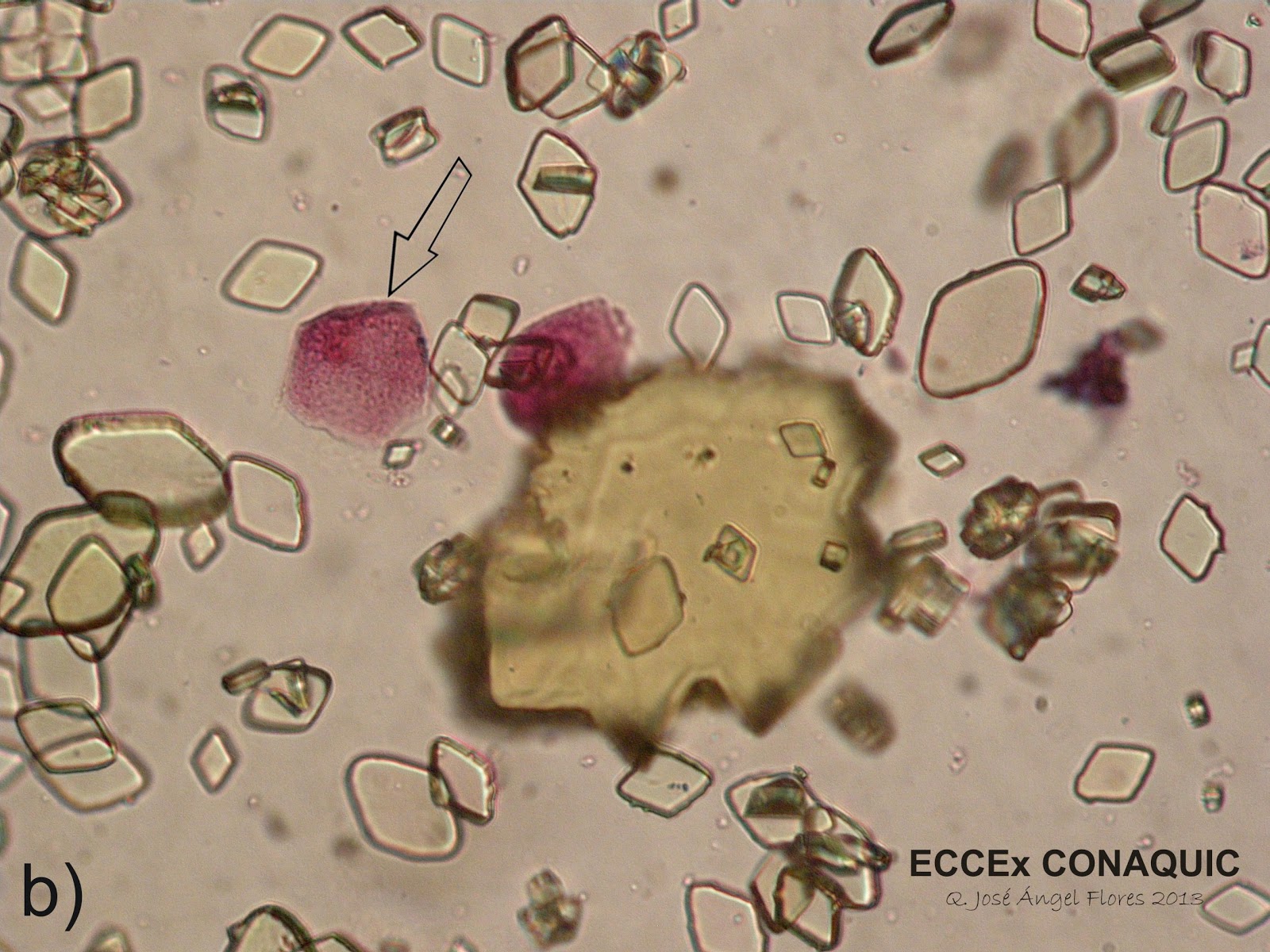 Caso UR- marzo-13 (Enfoque: cristaluria)