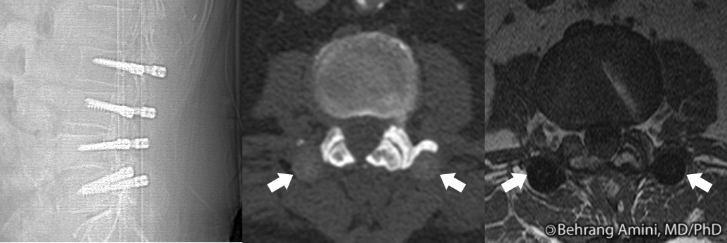 Roentgen Ray Reader: Posterior Dynamic Stabilization