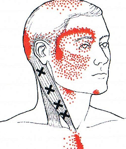 AbOut OH ! PhysiOtherapy: THE WORKSHOP OF 'DRY NEEDLING FOR MYOFASCIAL ...